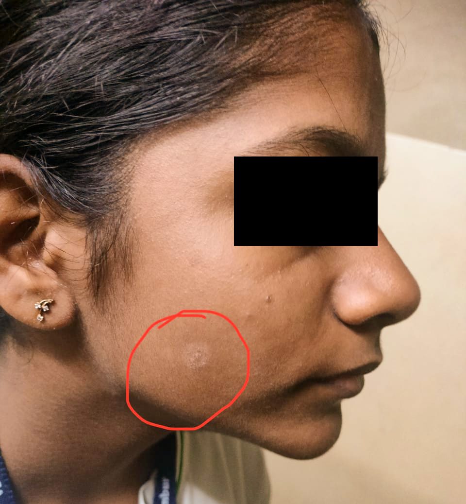 White Skin Spots On Face Infoupdate White Skin Spots On Face Infoupdate